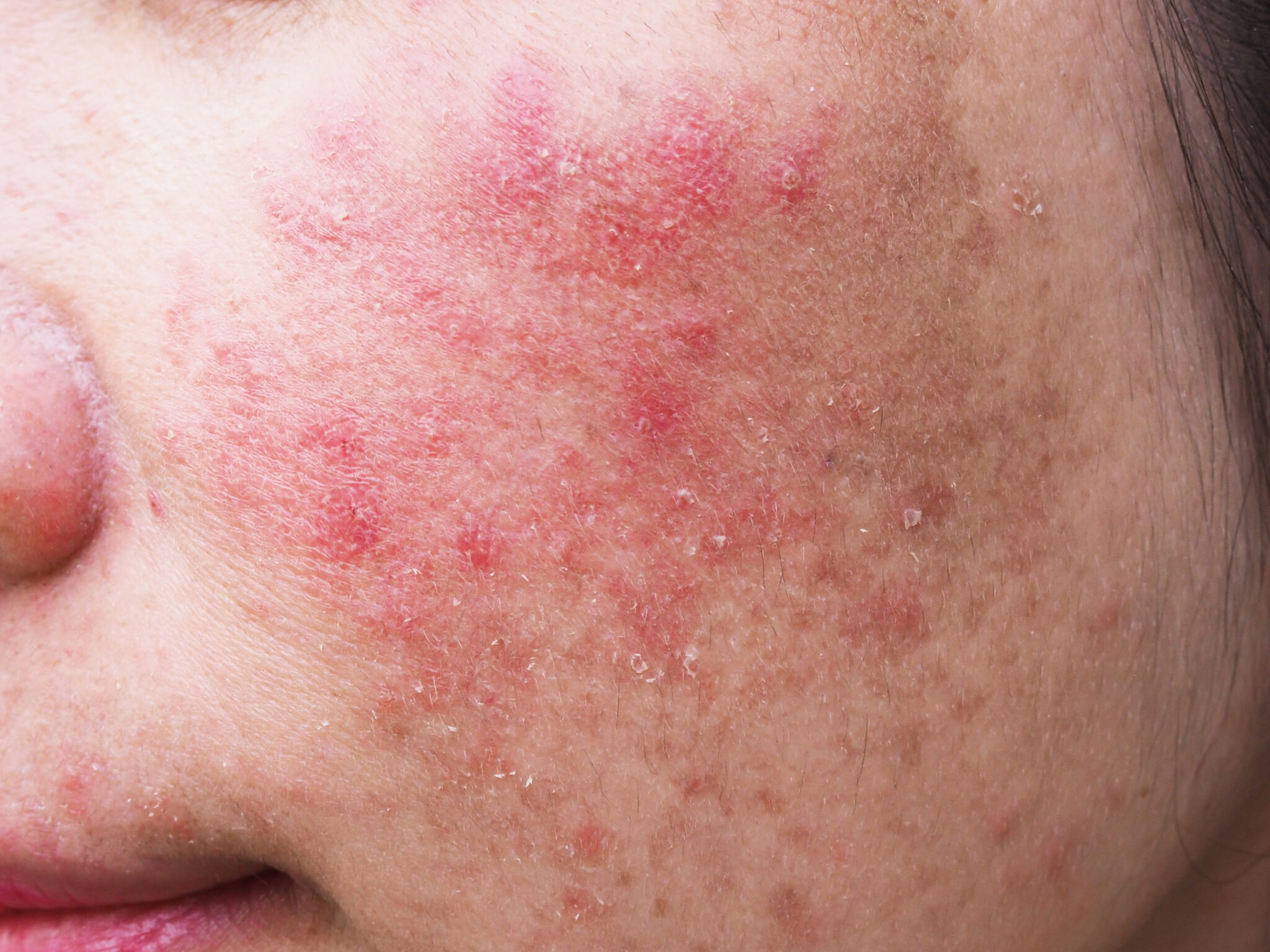 Rosacea Revealed: Beyond the Blush - Ageless Living Cold Lake