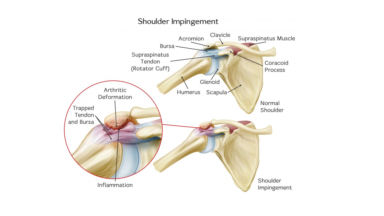 Therapia - Physiotherapy for Shoulder Pain